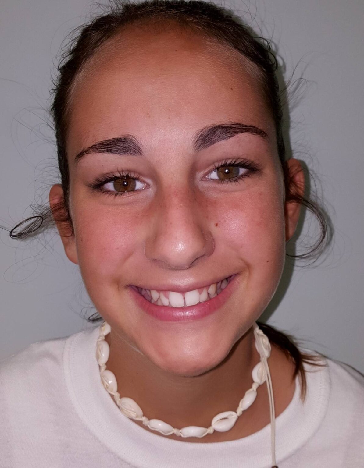 Before & Afters - Loew and Patel Orthodontics